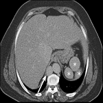 Polysplenia syndrome revealed in adulthood by pancreatic and vascular ...