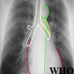 A cross-sectional epidemiological study of tuberculosis in the province ...