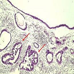 Serous endometrial intraepithelial carcinoma: a case report