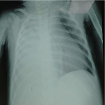 Staphylococcus aureus bacteremia with a mediastinal abscess in a 9 ...