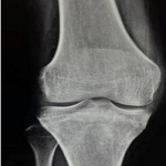 Chondroblastoma of proximal tibia diagnosed by arthroscopy-guided ...