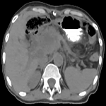 Pure squamous cell carcinoma of the pancreas: a rare and challenging ...