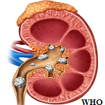 Epidémiologie et diagnostic de la lithiase urinaire: étude transversale ...