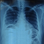 Raptured gas forming pyogenic liver abscess with a biliary fistula in ...