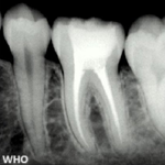Evaluation of radiographic quality of root canal obturation performed ...