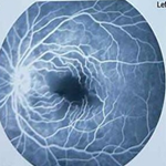 Sudden transient blindness following ureteroscopy: an uncommon ...