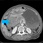 Gastroduodenal intussusception as a rare complication of ...