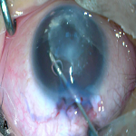 Encountering the clinical complexity of type II Peters anomaly ...