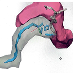 Pancreas divisum unmasked: a case report