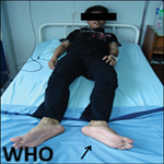 An early onset Gitelman syndrome presenting in a boy with failure to ...
