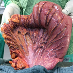 Left iliac fossa sigmoidectomy with mechanical anastomosis in the ...